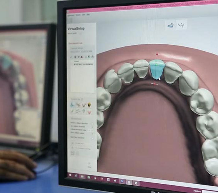 SmilePath Flex Easy Clear Aligner Plan for teeth straightening